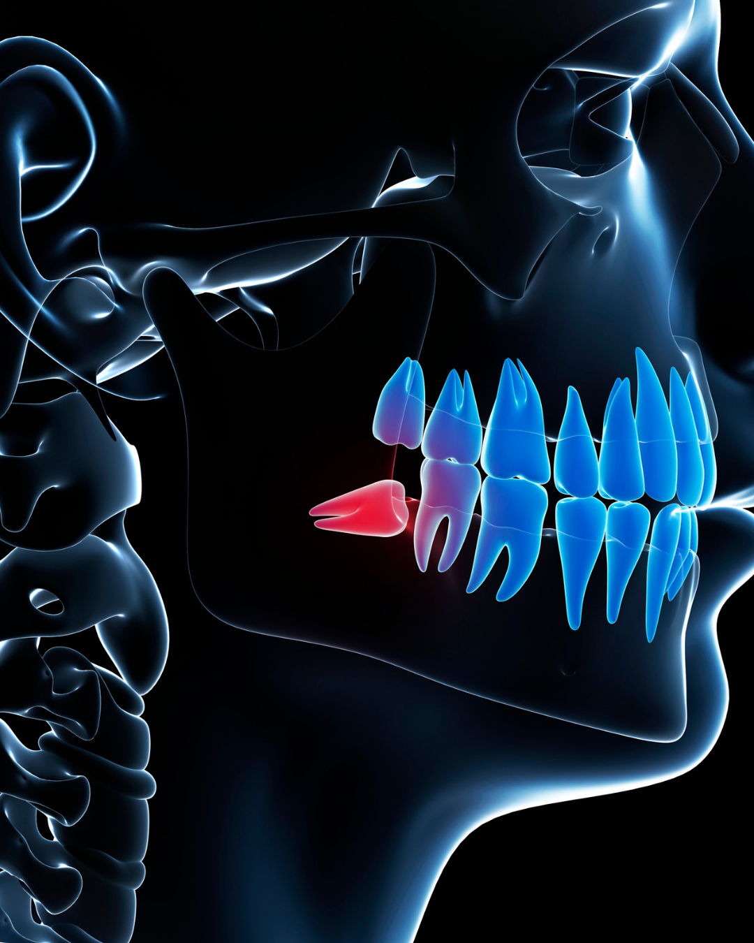 Dentes do Siso: Extração e Cuidados Relacionados